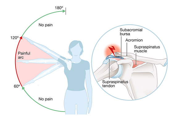QR CREAM FOR SHOULDER PAIN – QR Cream US